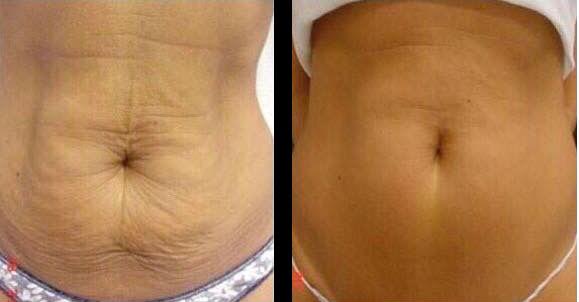 HIFU 4D Ultra Corporal | Tratamientos | Central Klinic