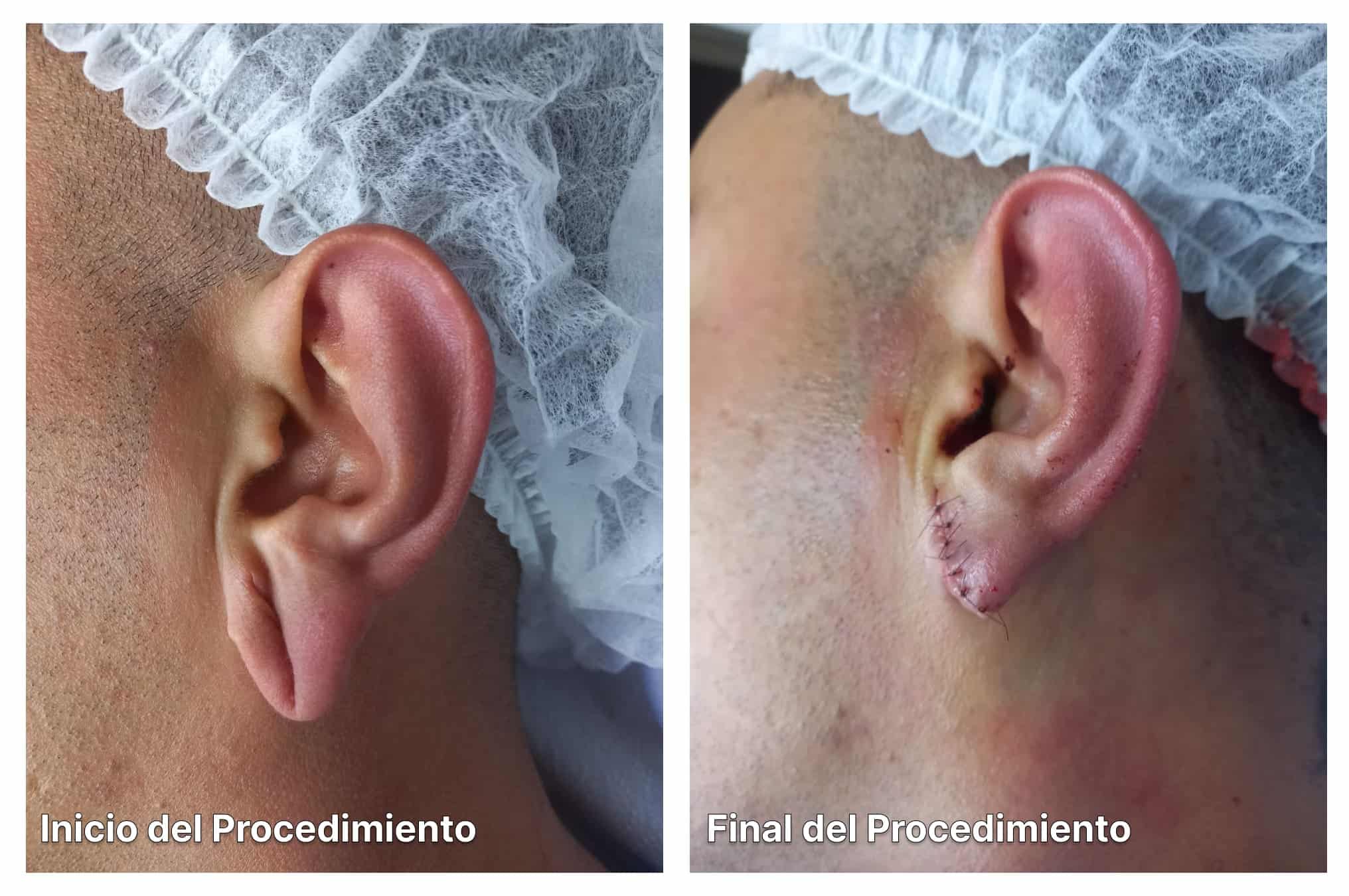 Lobuloplast a Reparaci n Del L bulo De La Oreja Central Klinic Lobuloplast a Reparaci n Del L bulo De La Oreja Central Klinic